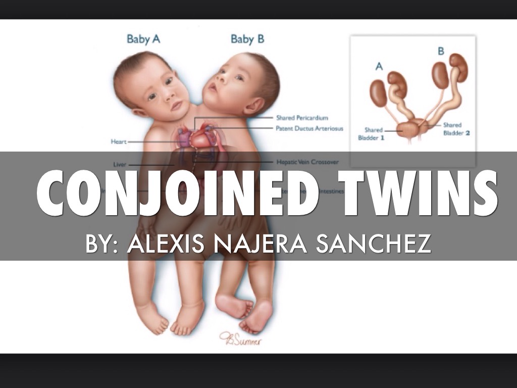 Conjonted Twins by Alexis Najera