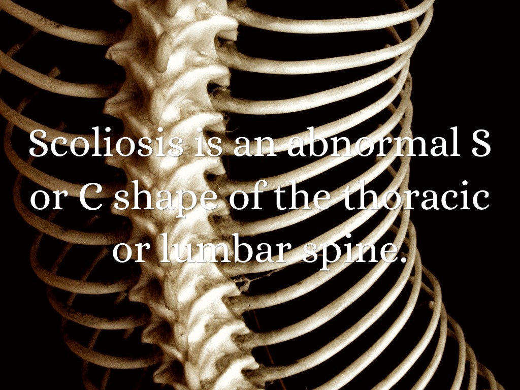 SCOLIOSIS by Skye Hagar