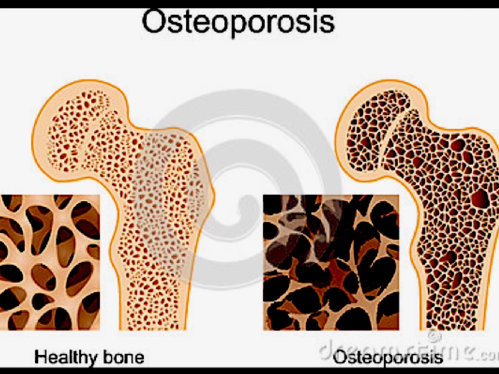 Biologie Les Osteoporose by Willianne Slootmaaker