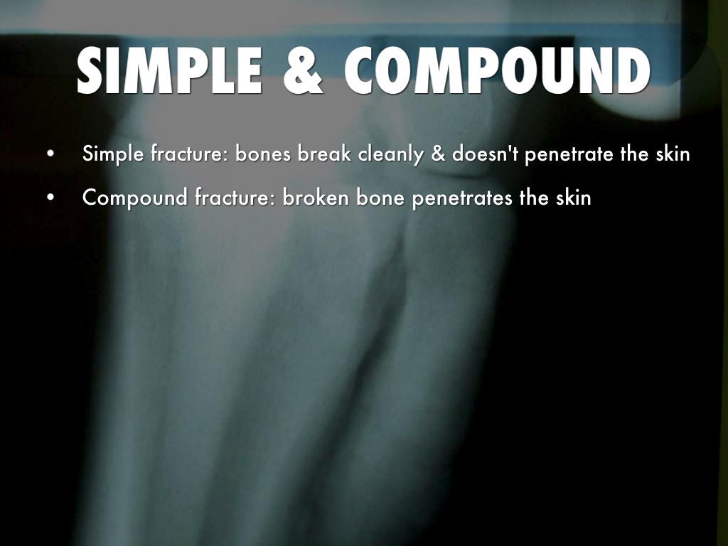 Bone Fractures by Madison Roberts