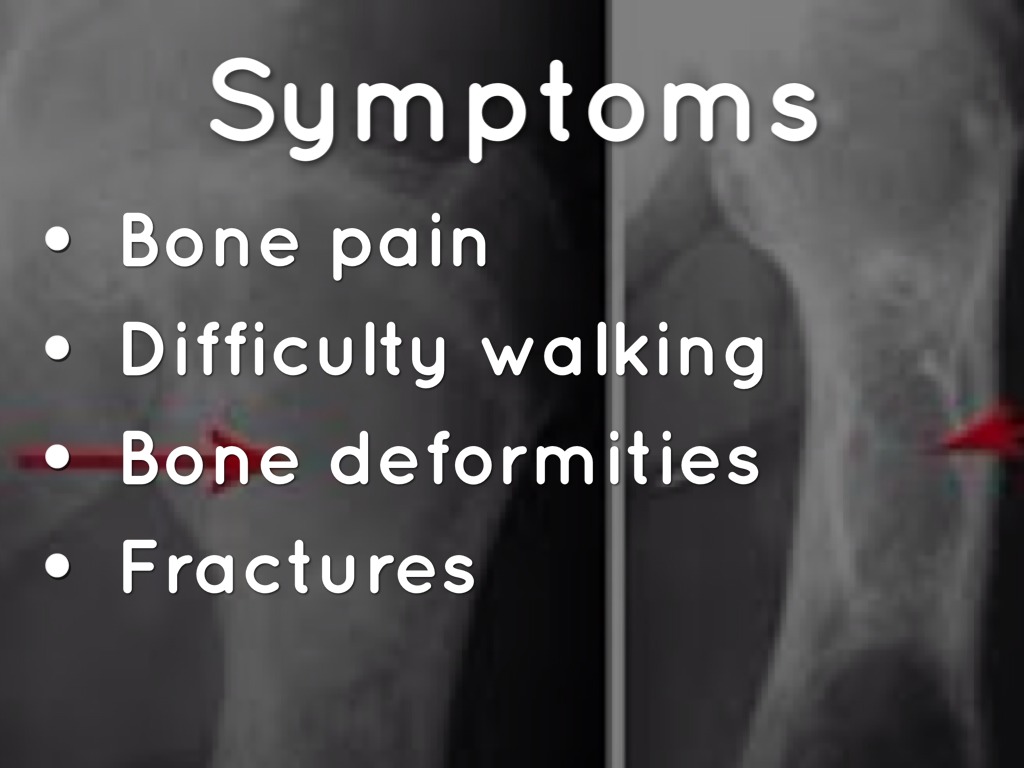 Bone Diseases by Alexis Bodie