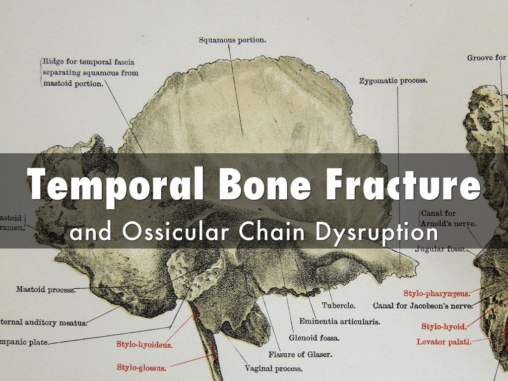 Temporal Bone Fracture by jeffseevers729