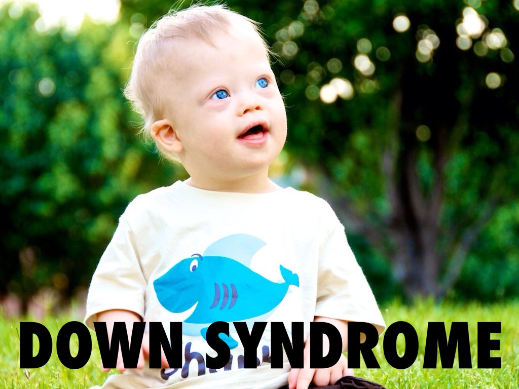 Down Syndrome by Tim Reis