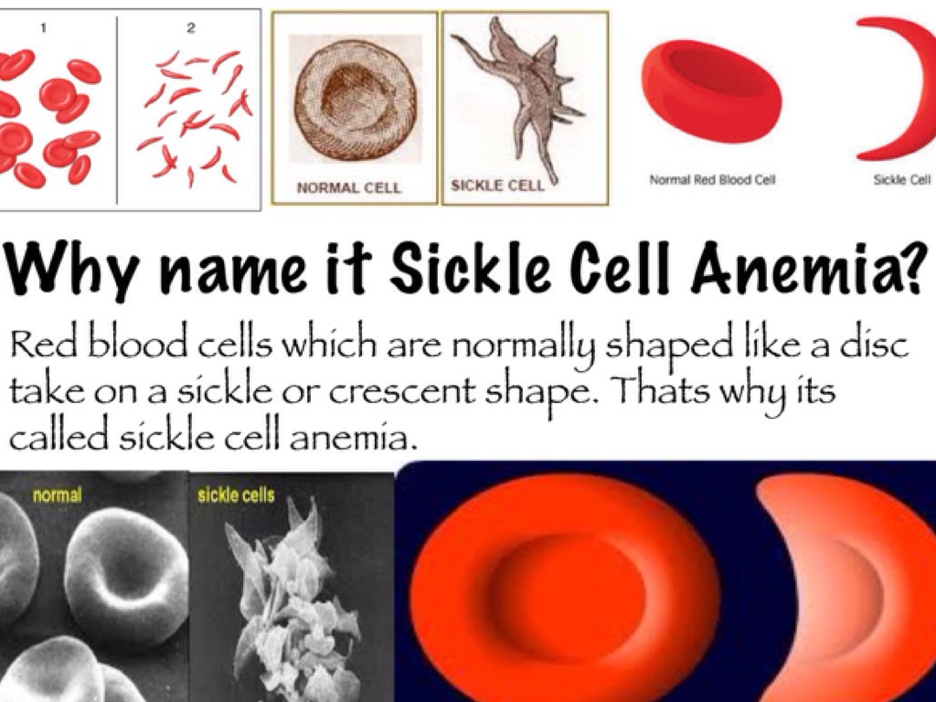 Sickle Cell Anemia By Live02thefullest