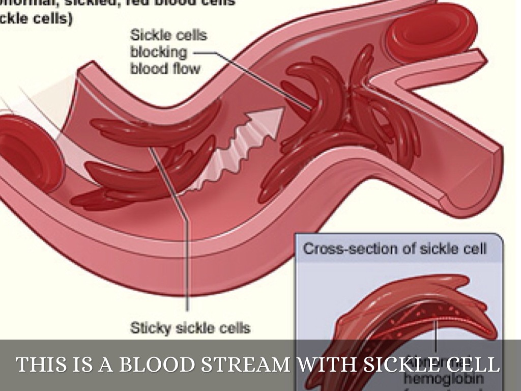 Sickle Disease by Austin Altizer