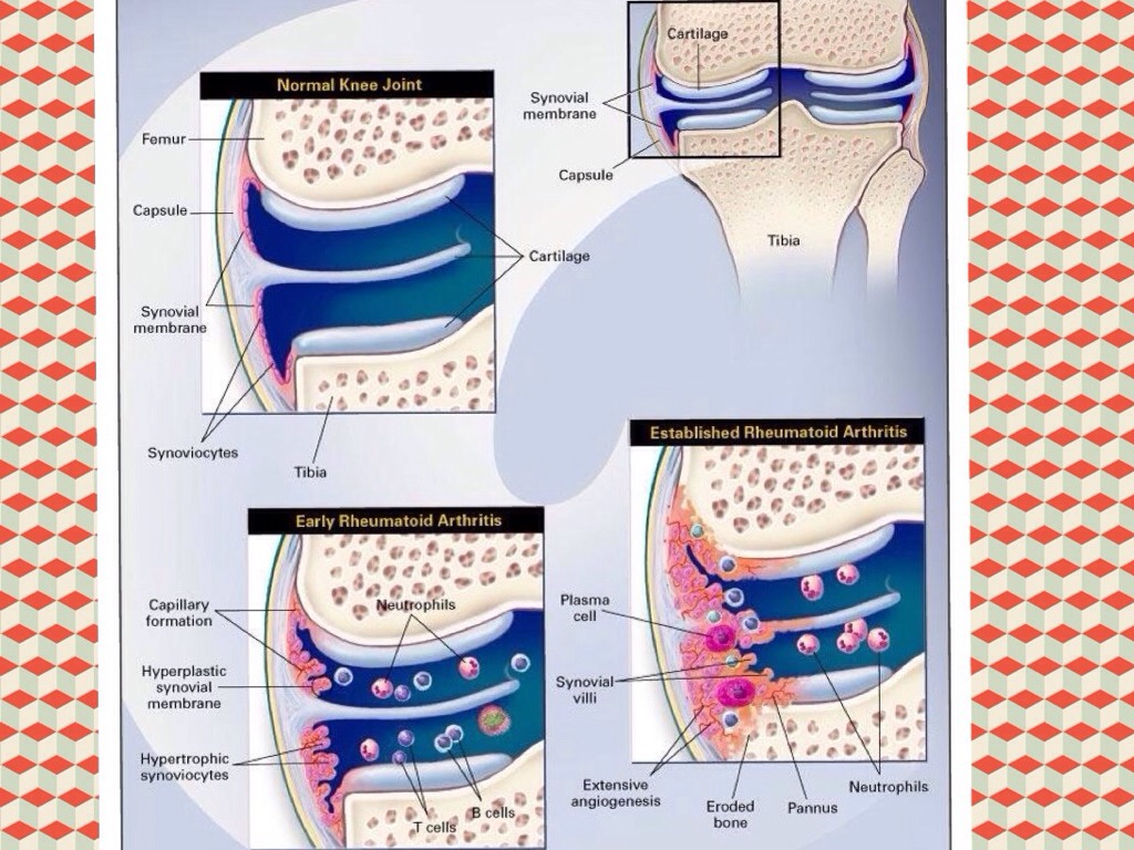 Reumatismo by Analuisa Rdz