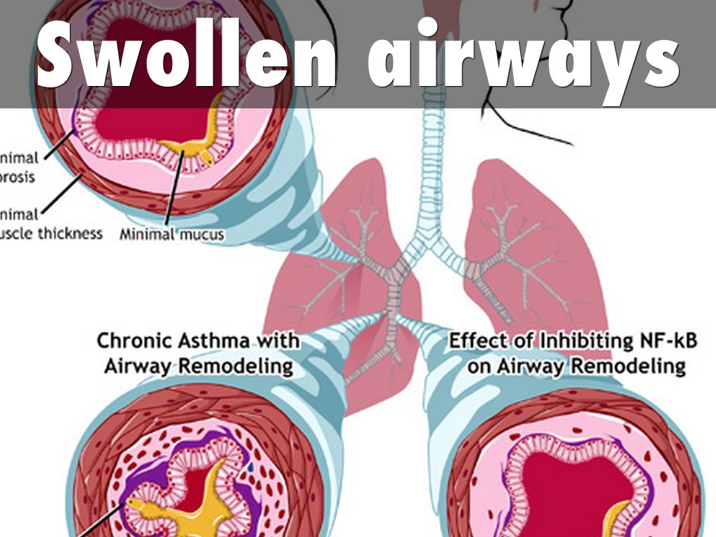 Asthma by David Clark by Students Lake Myra