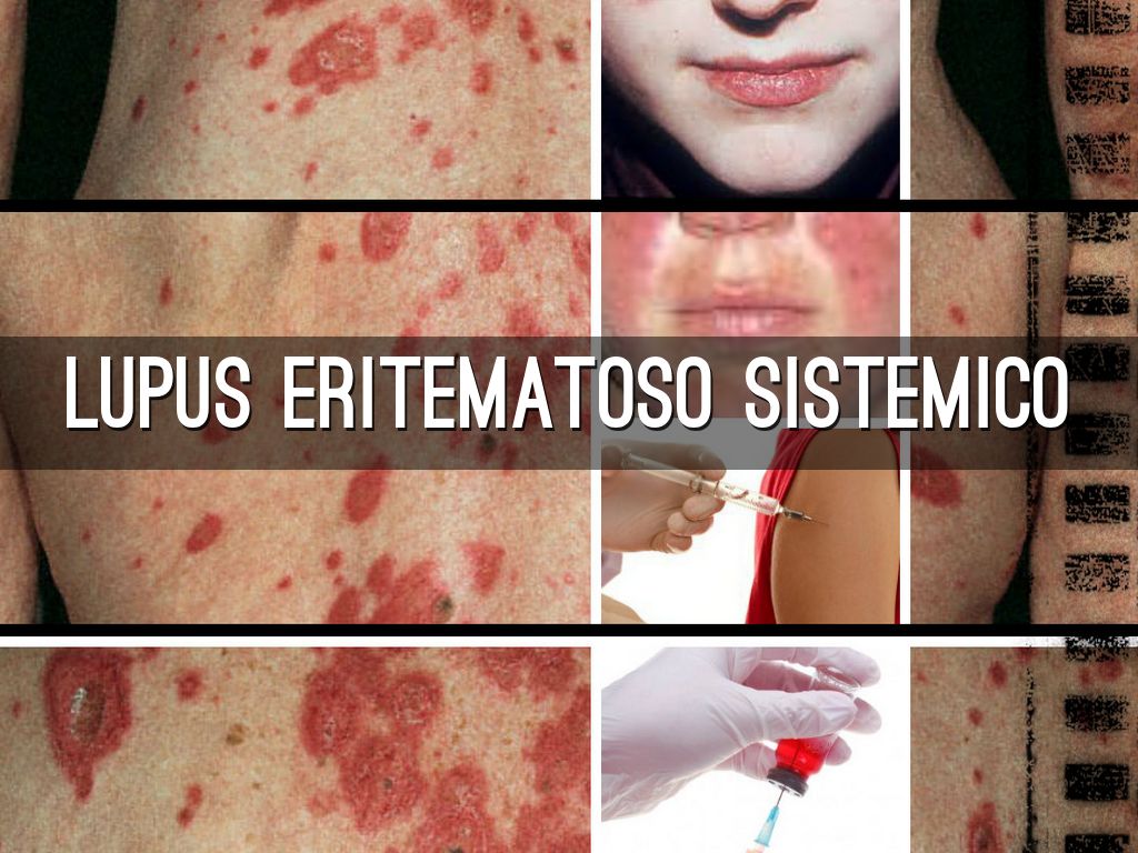 Lupus Eritematoso Sistemico by zenit721