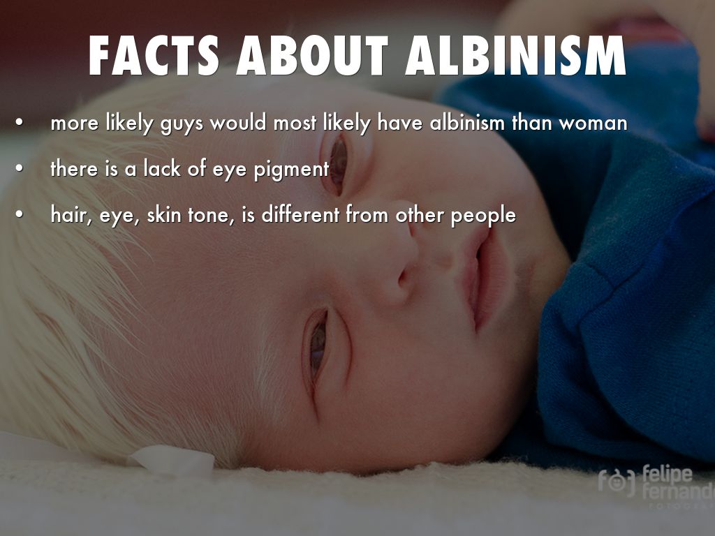 Albinism Genetics Facts