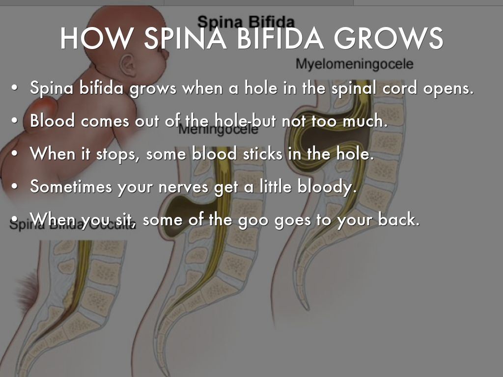 Spina Bifida by Giovvanna Palermo