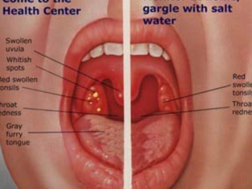 Laryngitis By Mcconville85 Laryngitis By Mcconville85