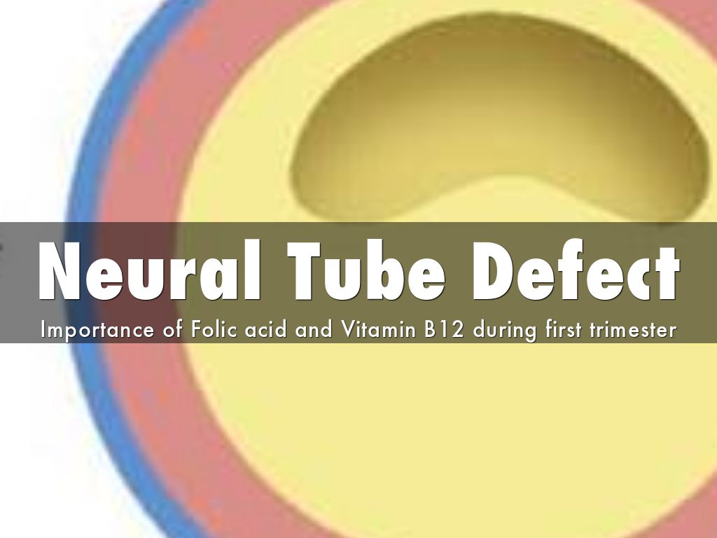 Neural Tube Defect by Vijaya Sawant