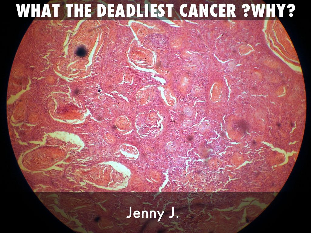 what the deadliest cancer ?why? by jenny.jimenez801